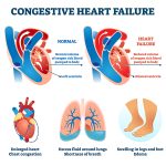 What Are Signs And Symptoms Of Fluid Overload In Heart Failure ...