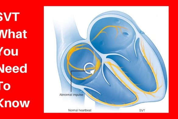 Arrhythmia Types, Symptoms, Causes, Diagnosis & Treatments ...
