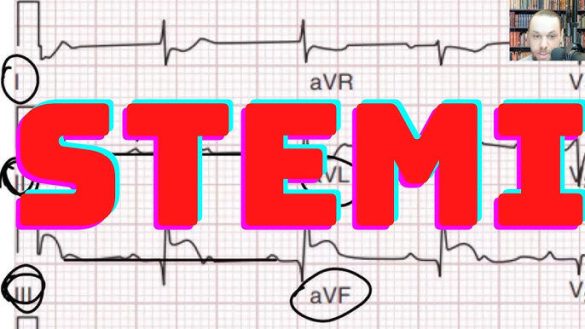 What Is 12-Lead Coronary Artery Scan? - Cardiovasculardiseasehub.com