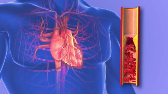 What Causes A Tear In The Heart Artery - Cardiovasculardiseasehub.com