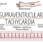 What Happens When A Heart Stent Fails - Cardiovasculardiseasehub.com