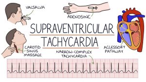 What Rate Is Considered SVT? - Cardiovasculardiseasehub.com