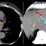 What Is Unspecified Hyperlipidemia? - Cardiovasculardiseasehub.com