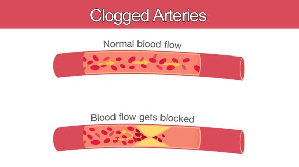 5 Major Causes Of Stable Coronary Artery Disease ...