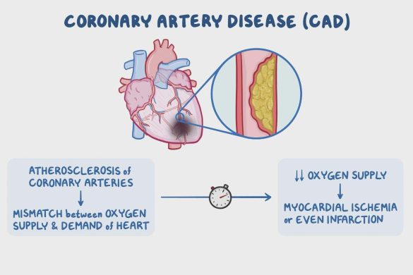 Coronary Arteriosclerosis In Native Arteries - Cardiovasculardiseasehub.com