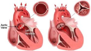 Can A Fall Cause Atrial Fibrillation (Afib)? - Cardiovasculardiseasehub.com