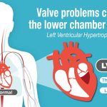 What Are The Side Effects Of Coronary Artery Disease ...