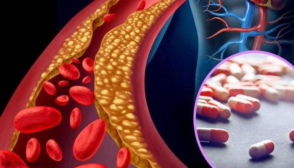 What Is Mixed Hyperlipidemia E78.2? - Cardiovasculardiseasehub.com