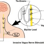 Can Too Much Calcium Cause Irregular Heartbeat ...