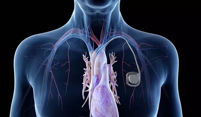 VA Palo Alto Performs First Optimizer Device Implant For Heart Failure ...