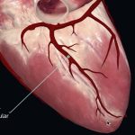 Left Circumflex Artery: Function, Anatomy & Location ...